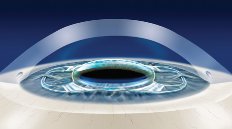 Implantable Contact Lenses • ICL : East Valley Eye Center - Burbank